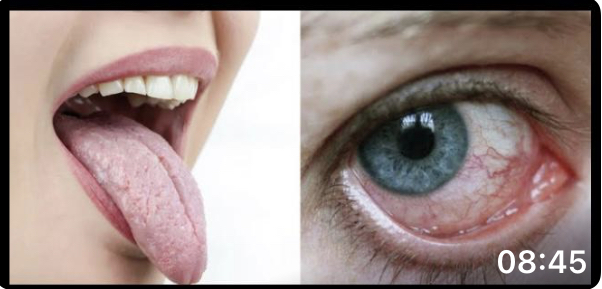 Síndrome de Sjogren ou Síndrome seca ou Sicca - Jornal Pequeno