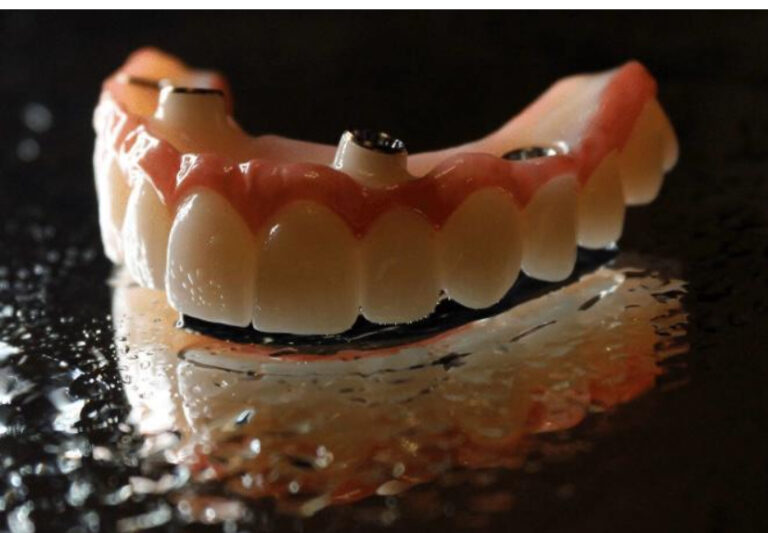 Prótese fixa tipo protocolo em Zircônia para desdentados totais ...